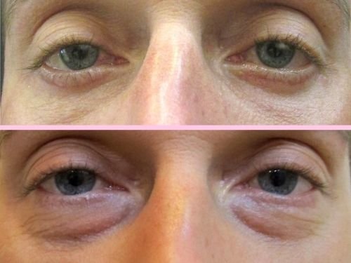 Blefaroplastika. Profesionální operace víček | BS Clinic Praha